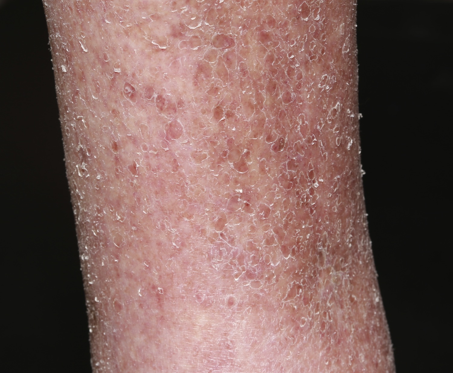 Xerosis. Parte 2. - Vida Abuelo