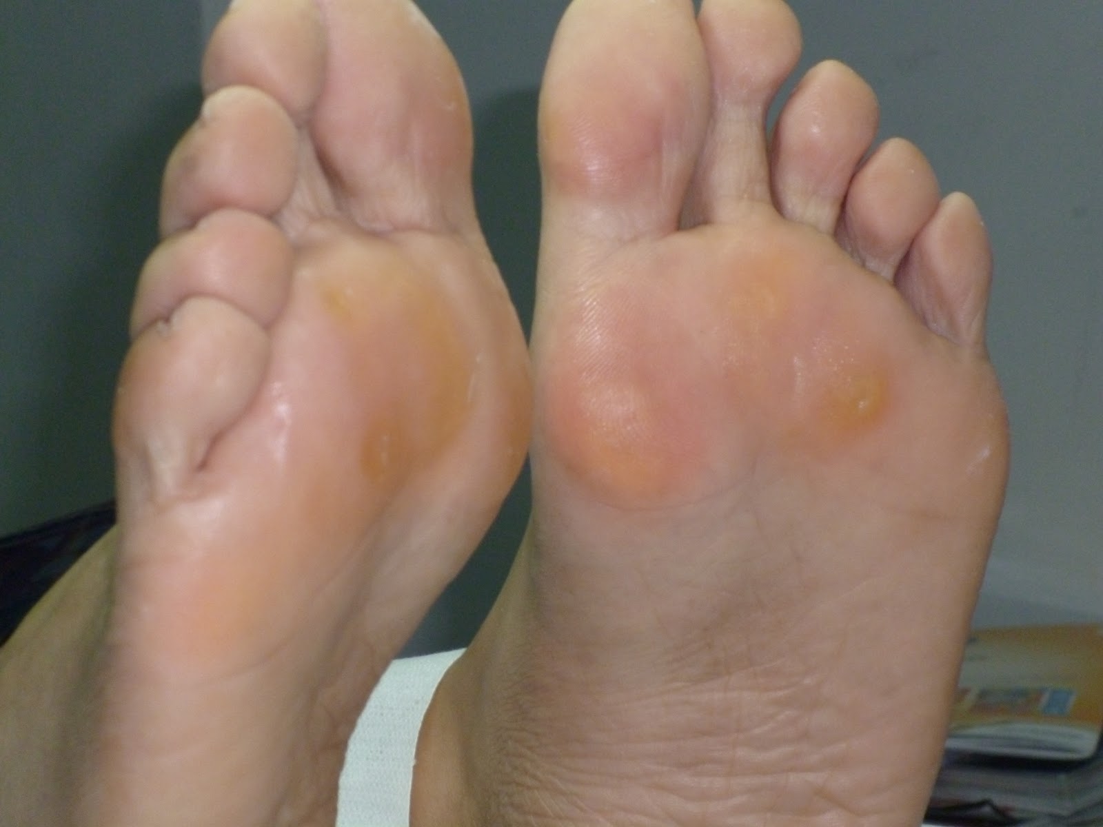 hiperqueratosis pie, hiperqueratosis en pie, hiperqueratosis planta